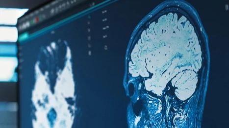 KBC Rijeka prvi u javnom zdravstvu uveo stereotaksijsku radioterapiju - HRT