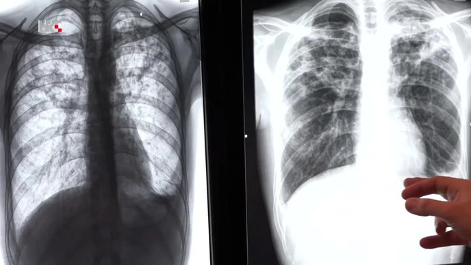 Uništava li pluća koronavirus ili naš imunitet? - HRT