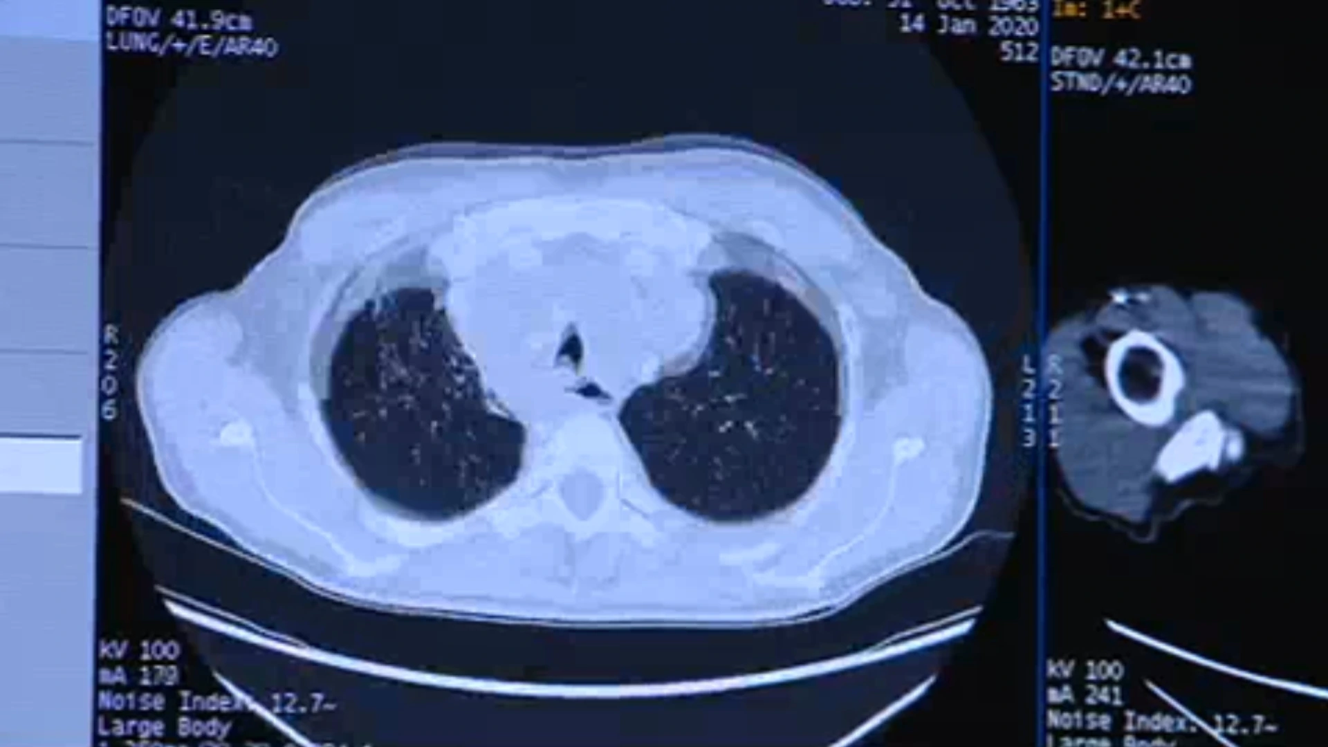 U KBC-u Zagreb prvi put u Hrvatskoj izvedena "Sleeve" resekcija pluća - HRT